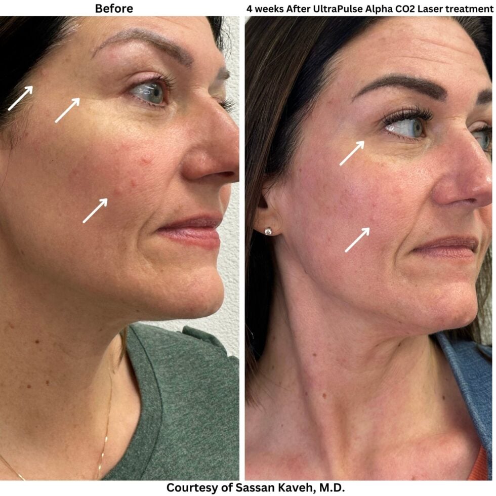 CO2 Laser Resurfacing Around Eyes: The Best Non-Surgical Fix for Fine ...