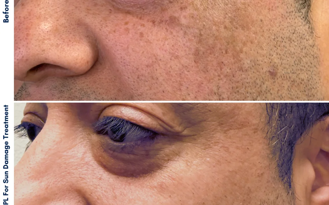 CO2 Laser Resurfacing Around Eyes: The Best Non-Surgical Fix for Fine ...