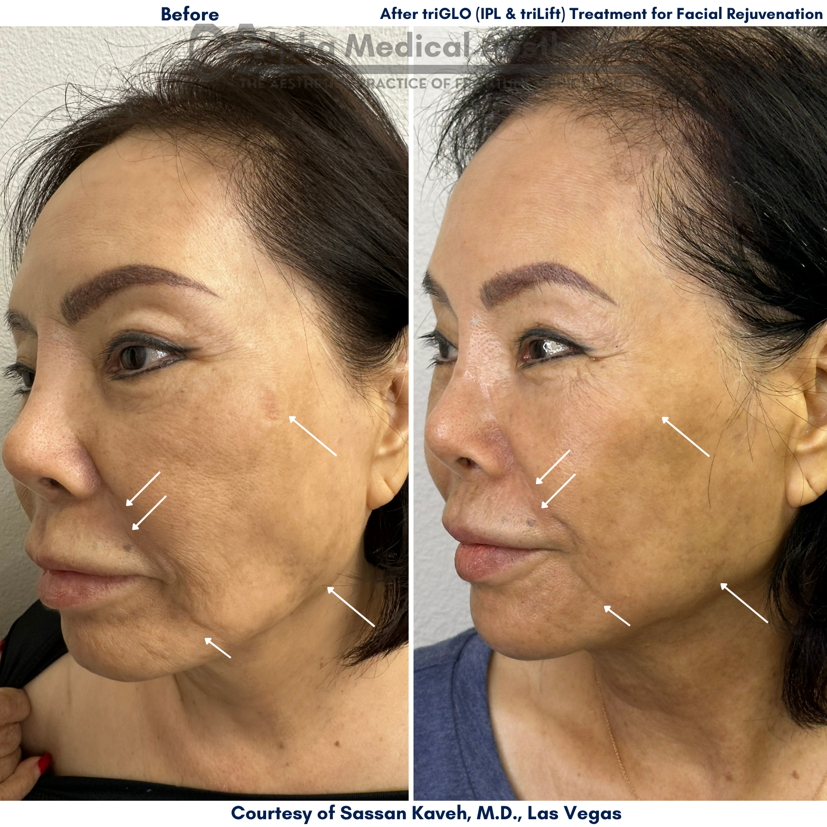 Non-Surgical Facelift in Las Vegas: triLift Before & After Results ...